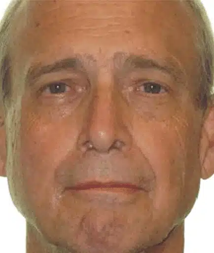 Homeoblock Treatment - Orthodontic Dental Appliance in Town Hall