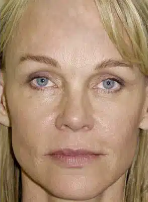 Homeoblock Treatment - Orthodontic Dental Appliance in Town Hall