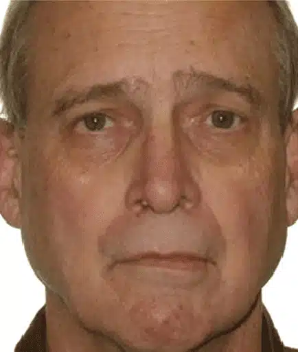 Homeoblock Treatment - Orthodontic Dental Appliance in Town Hall