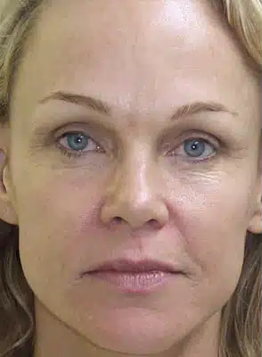 Homeoblock Treatment - Orthodontic Dental Appliance in Town Hall